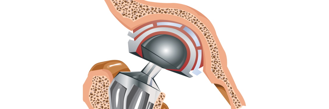 Gentle surgery methods make hip replacement less challenging